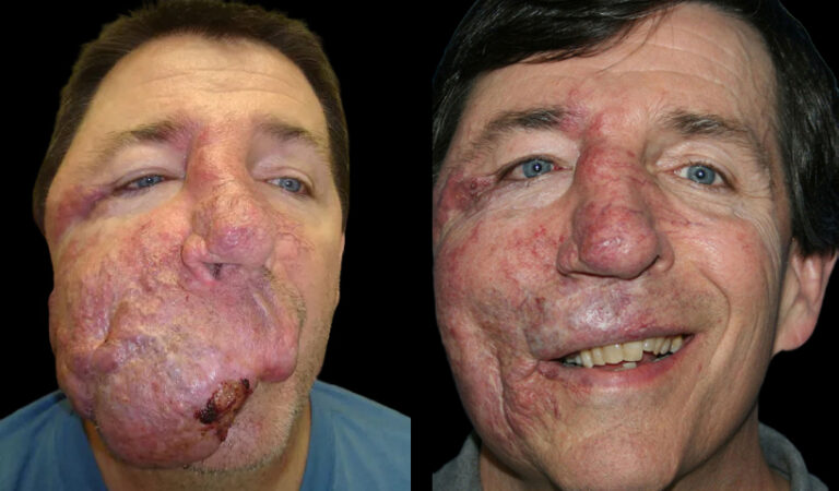 Arterio-Venous Malformations Face Before & Afters - Vascular Birthmark ...