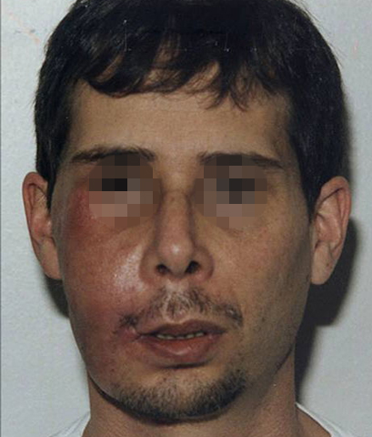Arterio-Venous Malformations Face 3 - Vascular Birthmark Institute