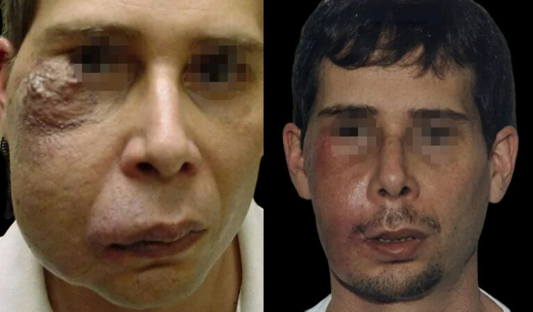 Arterio-Venous Malformations Face Before & Afters - Vascular Birthmark ...