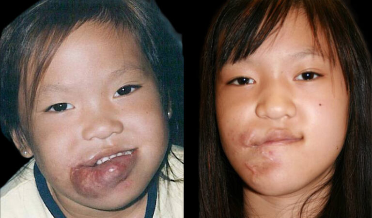 Arterio-Venous Malformations Lip Before & Afters - Vascular Birthmark ...