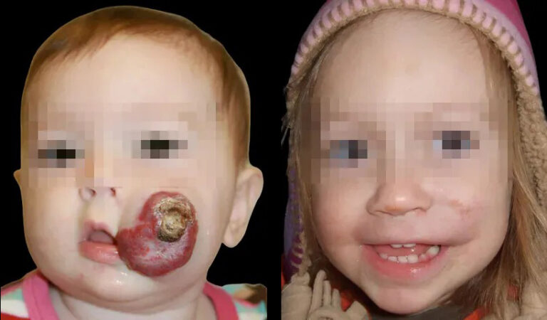 Hemangiomas Cheek 4 - Vascular Birthmark Institute