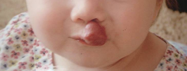 Hemangiomas Lip 2 - Vascular Birthmark Institute
