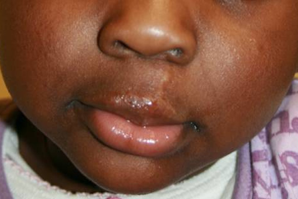 Hemangiomas Lip 3 - Vascular Birthmark Institute