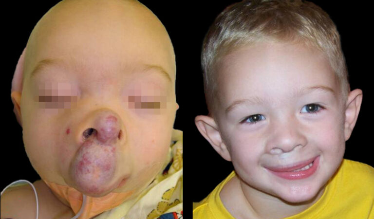 Hemangiomas Lip 2 - Vascular Birthmark Institute