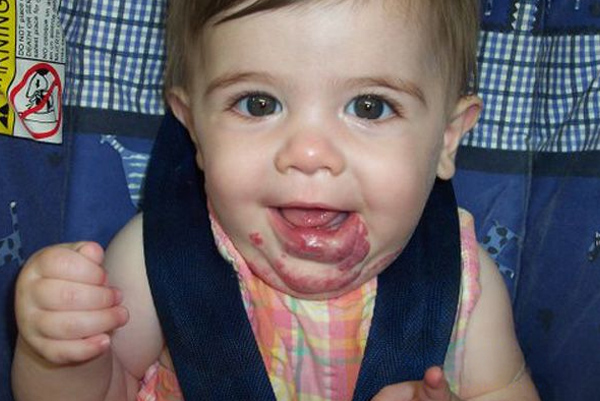 Hemangiomas Lip 9 - Vascular Birthmark Institute