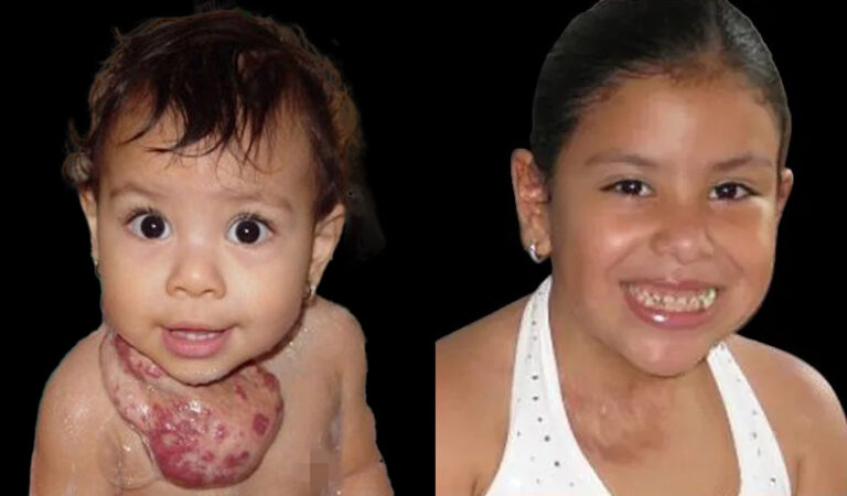 Hemangiomas Neck/Shoulder 2 - Vascular Birthmark Institute