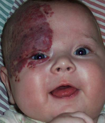 Hemangiomas Segmental 5 - Vascular Birthmark Institute