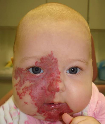 Hemangiomas Segmental 6 - Vascular Birthmark Institute