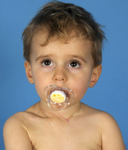 Lymphatic Malformations 2 - Vascular Birthmark Institute