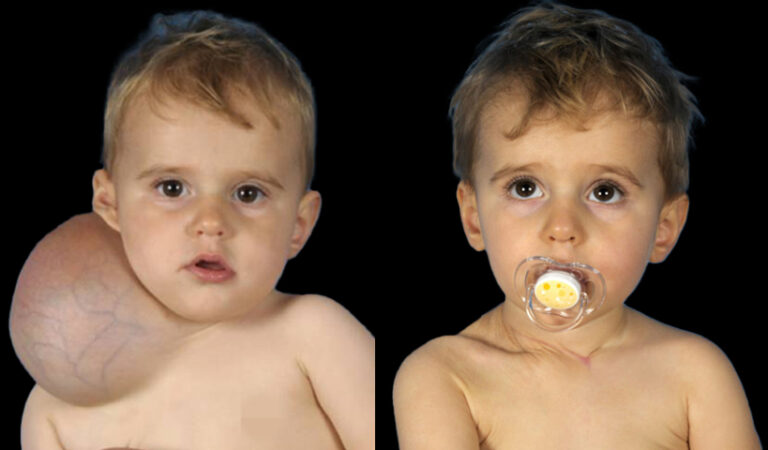 Lymphatic Malformations Overview Before & Afters - Vascular Birthmark ...