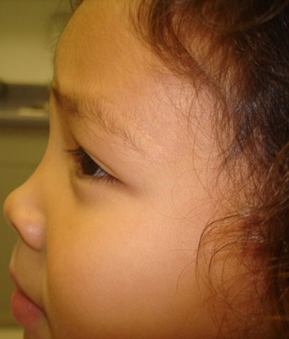 Lymphatic Malformations Forehead/Temple 2 - Vascular Birthmark Institute