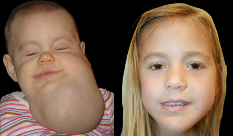 Lymphatic Malformations Neck Before & Afters - Vascular Birthmark Institute