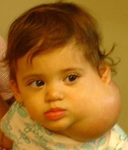 Lymphatic Malformations Neck 2 - Vascular Birthmark Institute