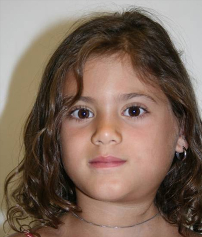 Lymphatic Malformations Neck 2 - Vascular Birthmark Institute