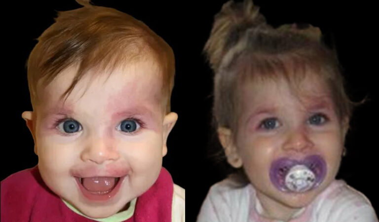 Port Wine Stains Laser Before & Afters - Vascular Birthmark Institute