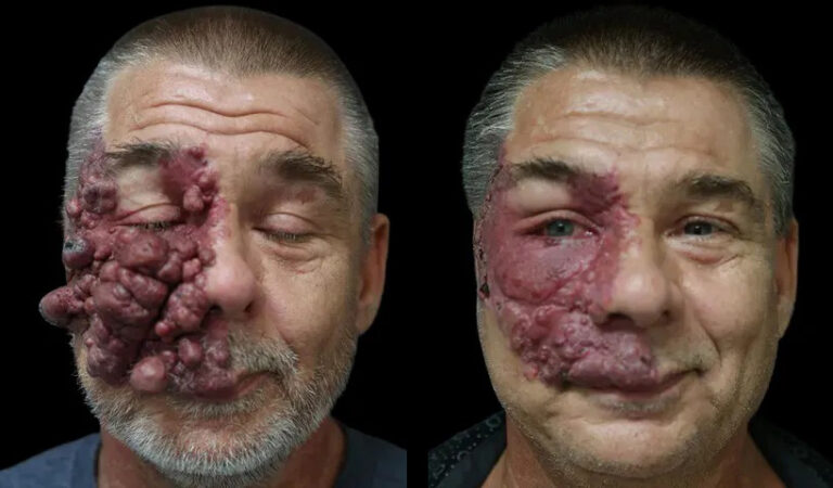 Port Wine Stains Face Before & Afters - Vascular Birthmark Institute