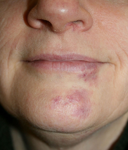 Port Wine Stain Face 3 - Vascular Birthmark Institute