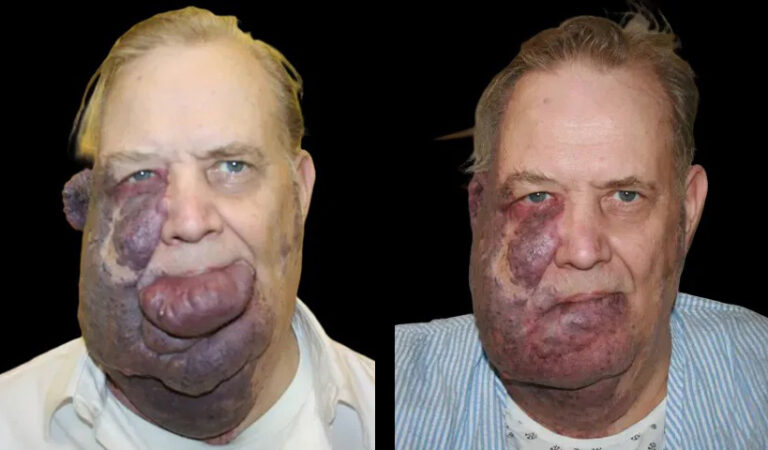 Port Wine Stains Face Before & Afters - Vascular Birthmark Institute