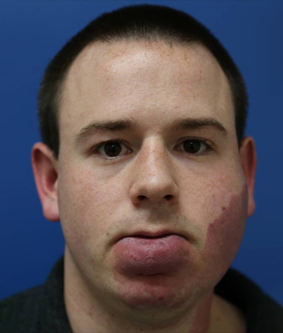 Port Wine Stain Face 7 - Vascular Birthmark Institute