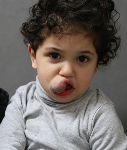 Venous Malformations Lip 1 - Vascular Birthmark Institute