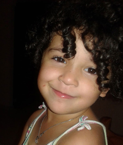 Venous Malformations Lip 1 - Vascular Birthmark Institute