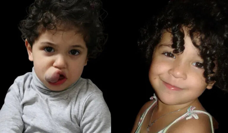 Venous Malformations Lip Before & Afters - Vascular Birthmark Institute