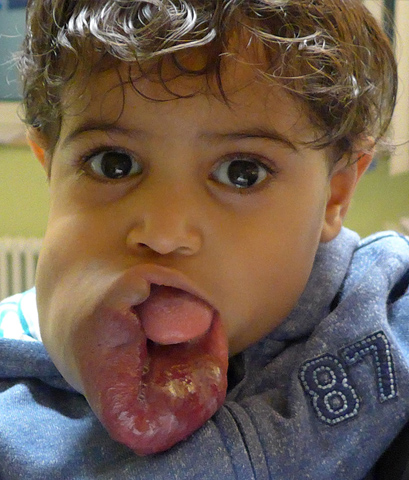 Venous Malformations Lip 2 - Vascular Birthmark Institute