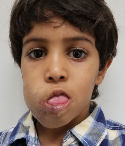 Venous Malformations Lip 2 - Vascular Birthmark Institute