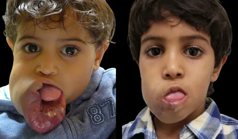 Venous Malformations Lip 2 - Vascular Birthmark Institute