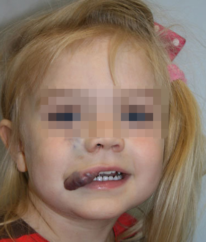 Venous Malformations Lip 3 - Vascular Birthmark Institute