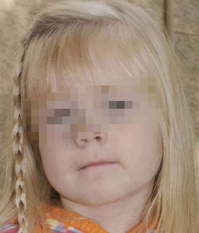 Venous Malformations Lip 3 - Vascular Birthmark Institute