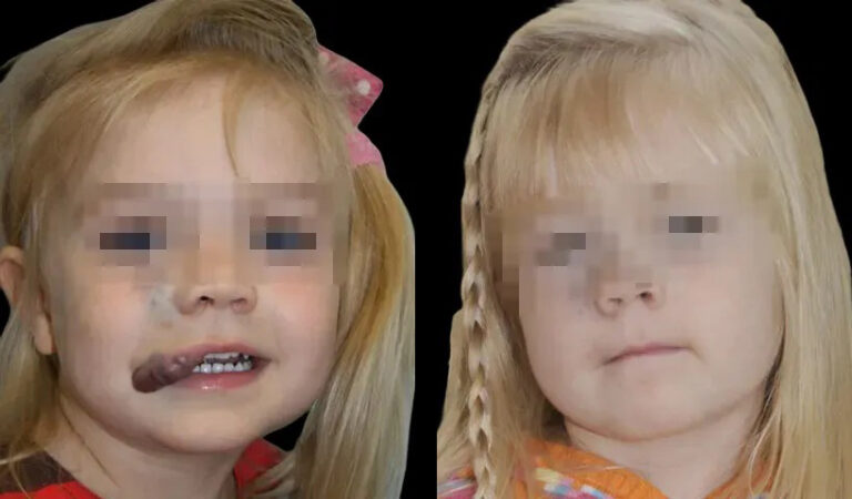 Venous Malformations Lip 2 - Vascular Birthmark Institute