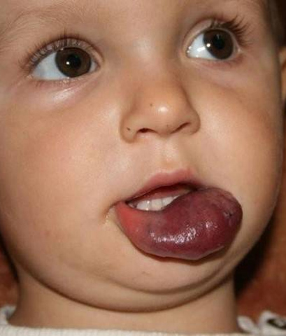 Venous Malformations Lip 4 - Vascular Birthmark Institute