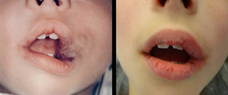 Venous Malformations Lip 2 - Vascular Birthmark Institute