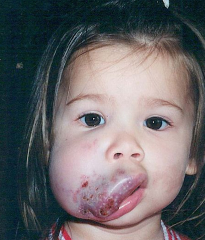 Venous Malformations Lip 9 - Vascular Birthmark Institute