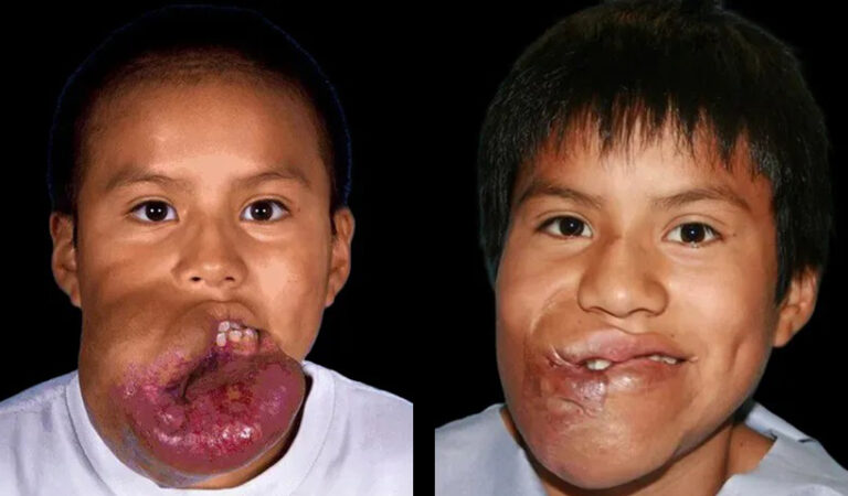 Venous Malformations Cheek/Neck Before & Afters - Vascular Birthmark ...