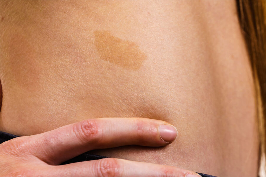 Congenital Birthmarks in NYC | Vascular Birthmark Institute