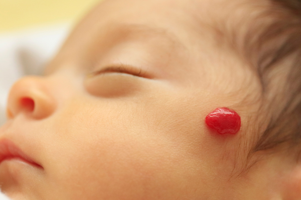 About Infantile Hemangiomas | Vascular Birthmark Institute in NYC