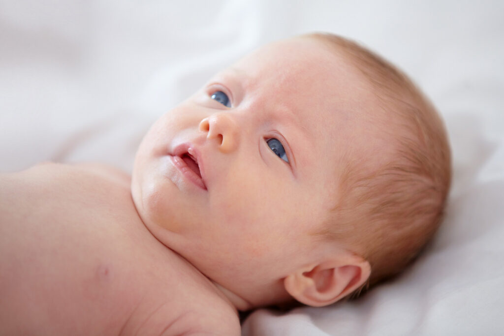 Midline Venular Malformation | Vascular Birthmark Institute in NYC