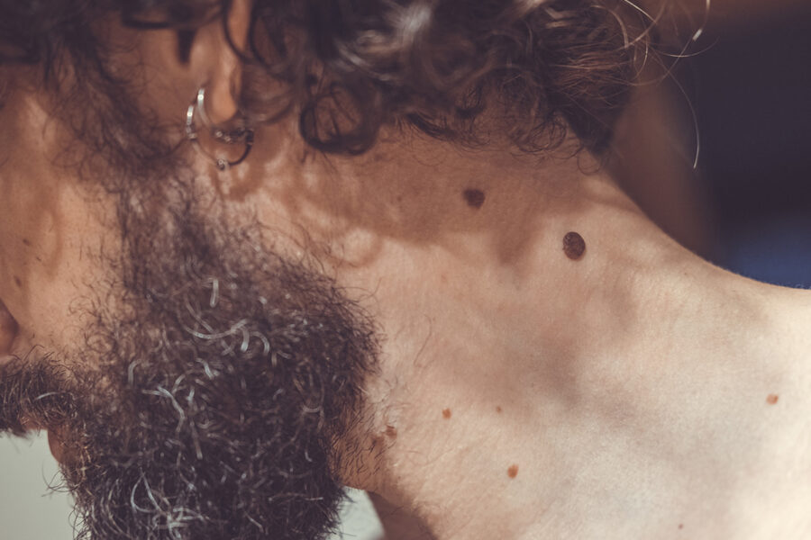 About Nevus | Vascular Birthmark Institute in NYC