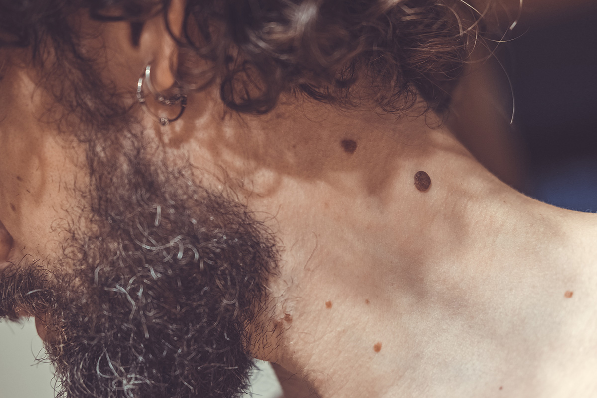 About Nevus | Vascular Birthmark Institute in NYC