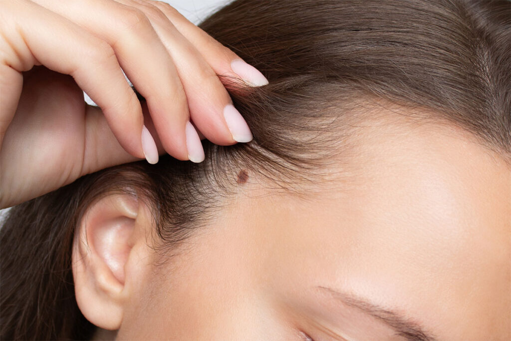 About Nevus | Vascular Birthmark Institute in NYC